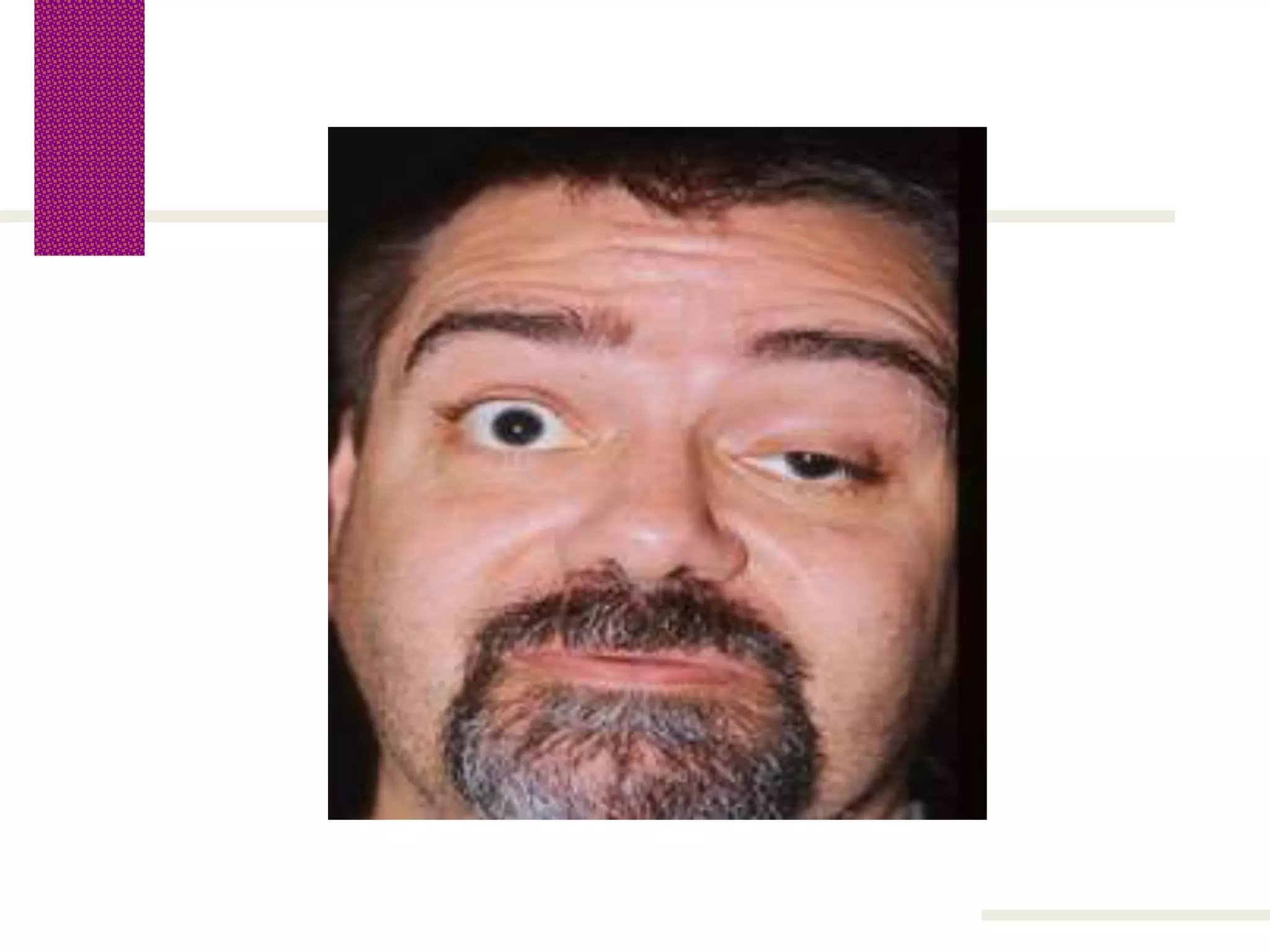 Myasthenia gravis (Ascending Disease) | PPTX