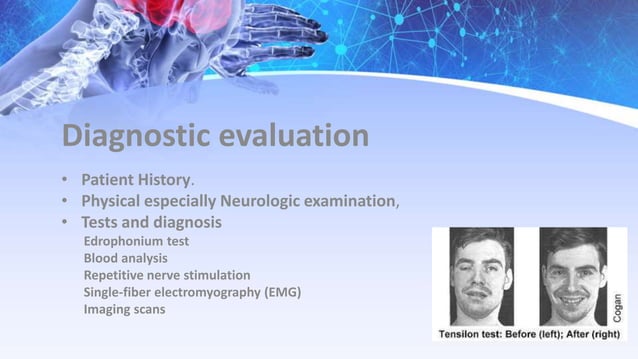 myasthenia gravis ppt.pptx | Brain and Nervous System Disorders ...