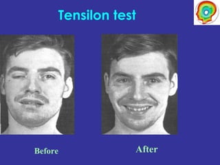 Myasthenia gravis Walid Reda Ashour | PPT