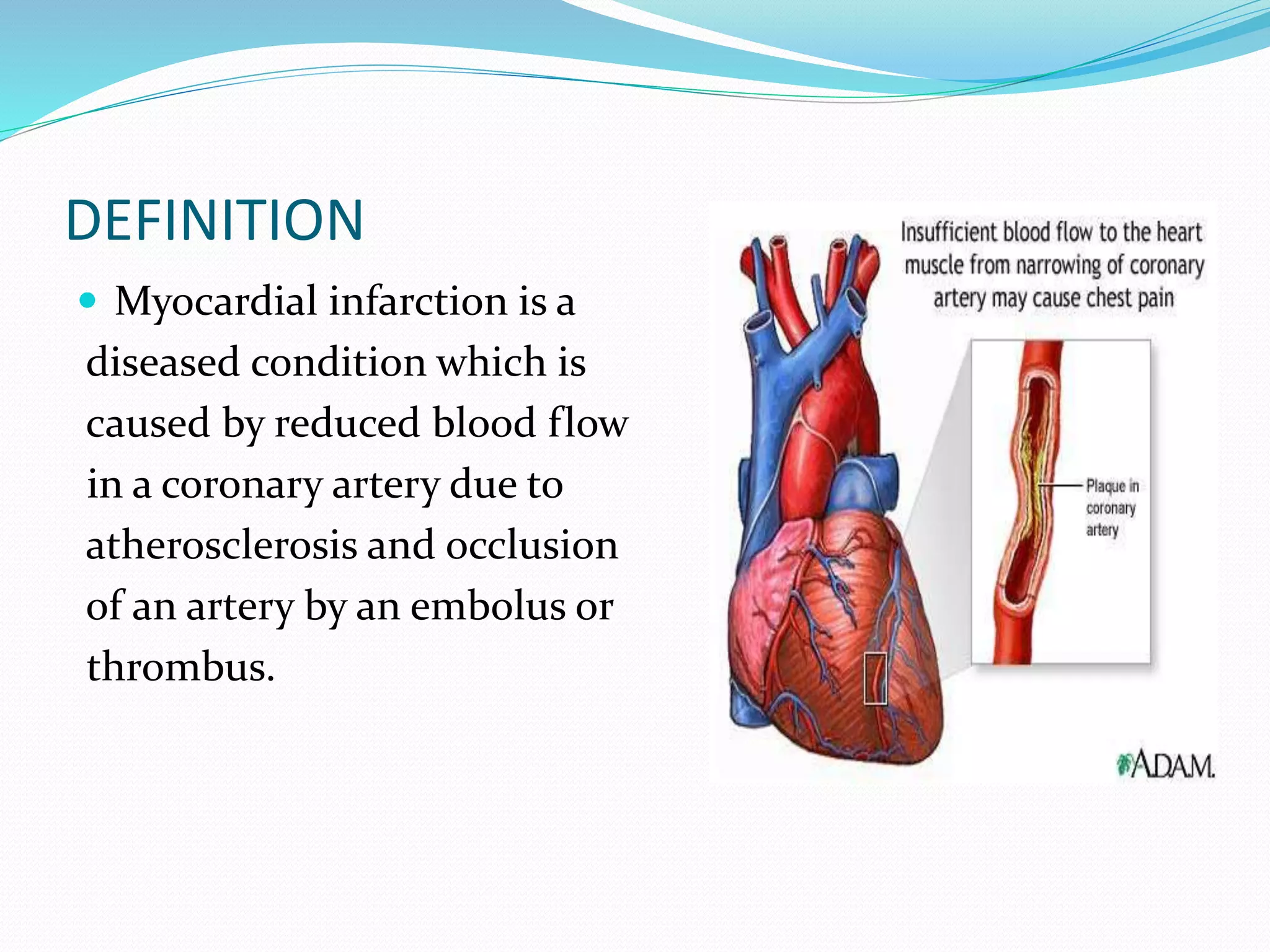 Mycardial infraction.ppt