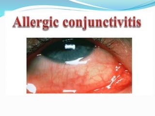 VERNAL KERATO CONJUNCTIVITIS | PPTX