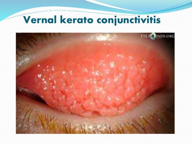 VERNAL KERATO CONJUNCTIVITIS