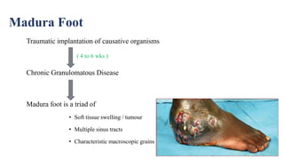 Mycetoma, madura foot | PPTX