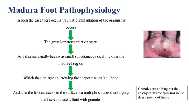 Mycetoma, madura foot
