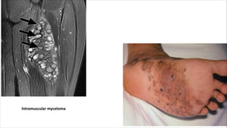 MYCETOMA infectious diseases ppt-2.pdf