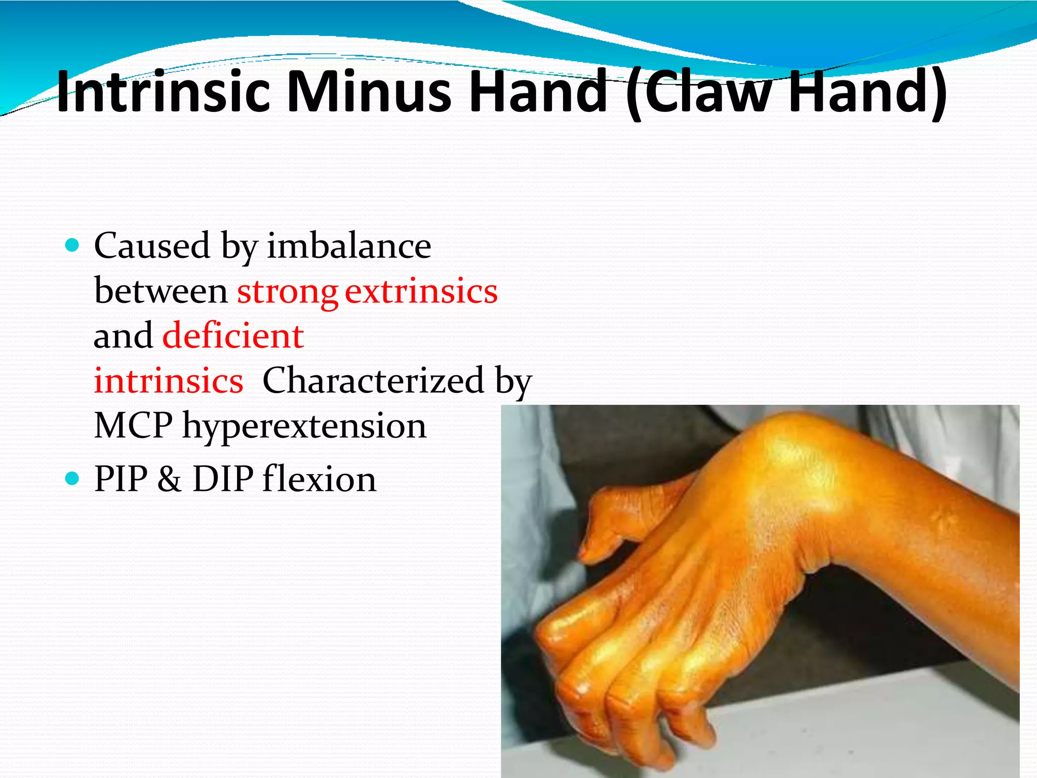 Claw hand | PPTX