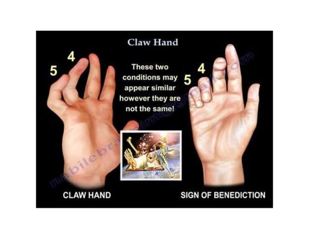 Claw hand | PPTX | Death, Injury, or Military Conflict | Sensitive Topics