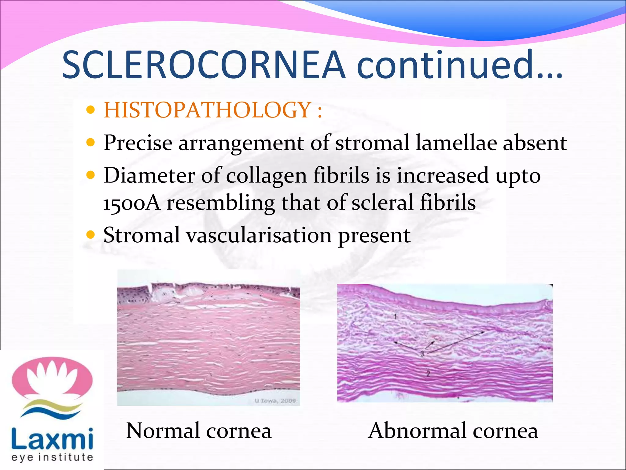 My Clouding Cornea | PPTX
