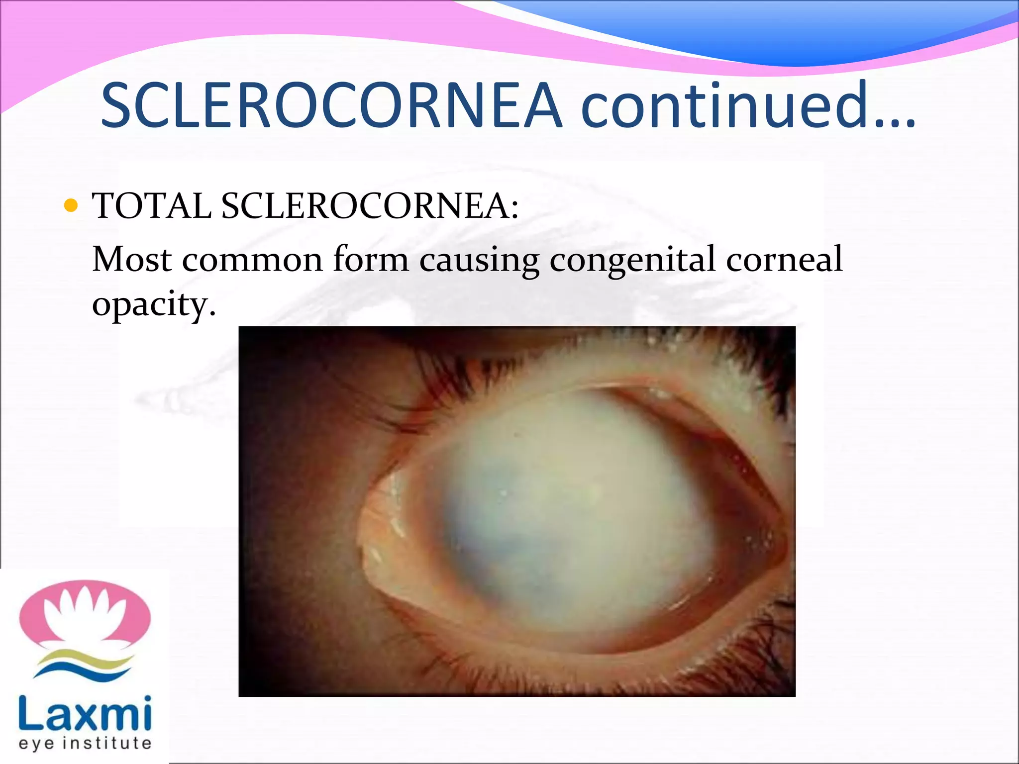 My Clouding Cornea | PPTX