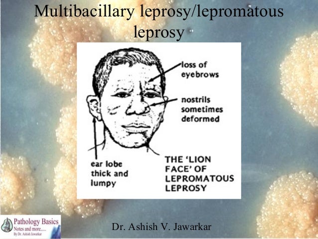 Leprosy Lion Face