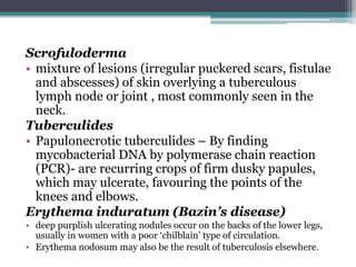 Mycobacterial dz | PPT