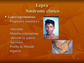 Mycobacterium Leprae | PPT