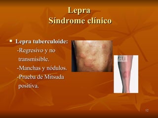 Mycobacterium Leprae | PPT
