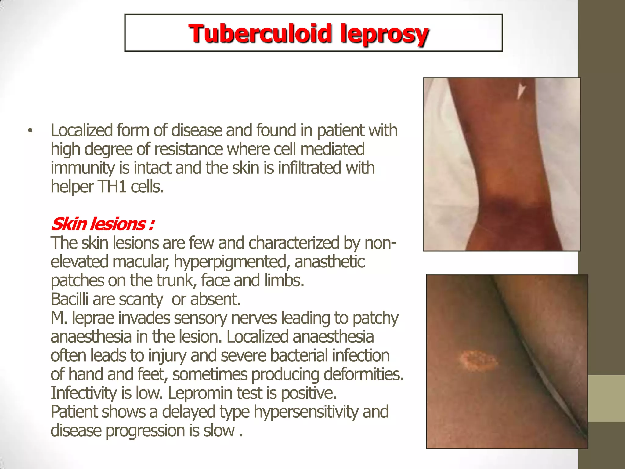 Mycobacterium leprae | PPT