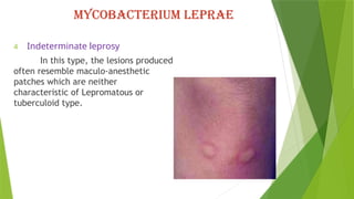 Medical bacteriology,Mycobacterium leprae | PPT