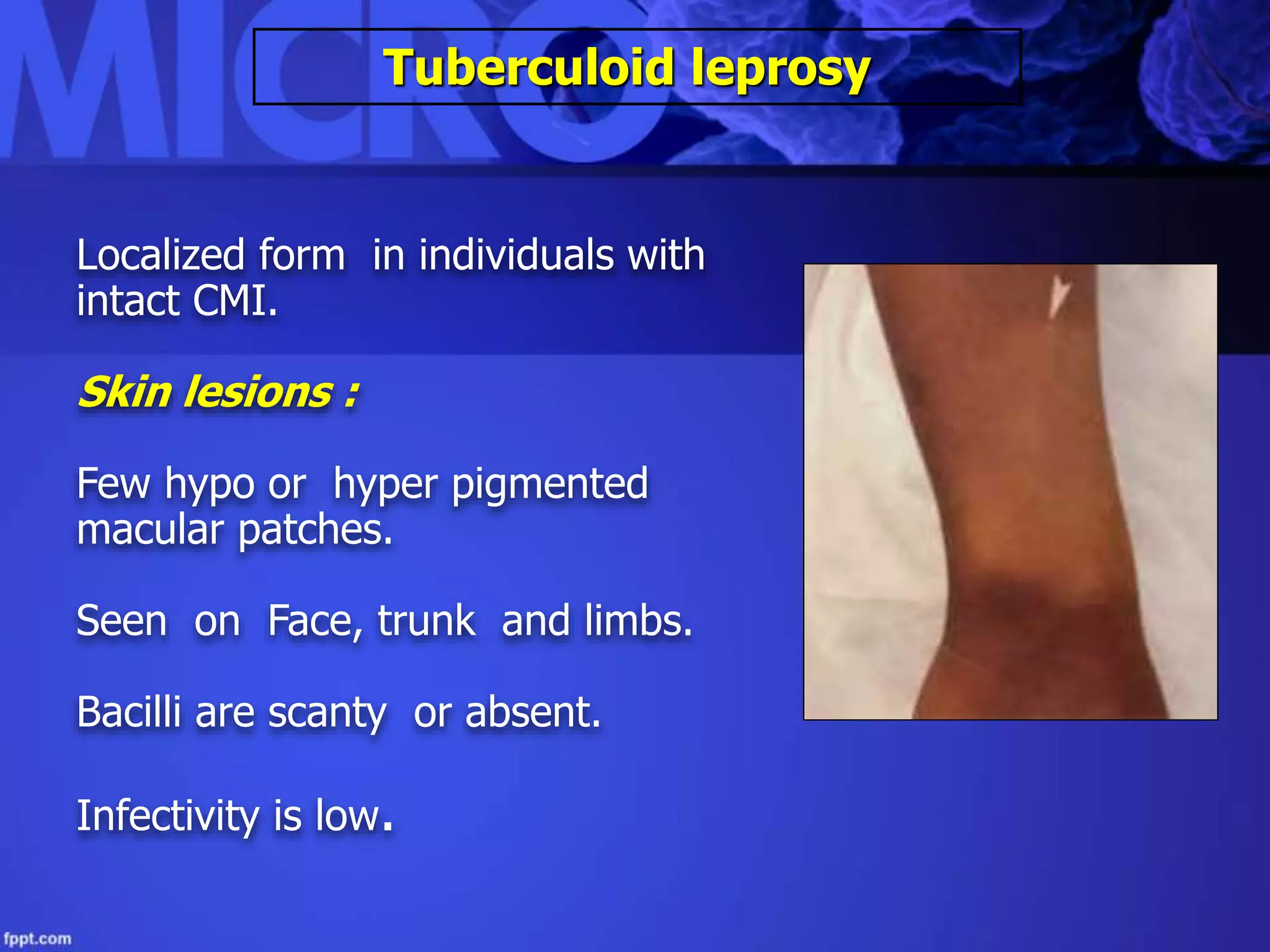 Mycobacterium leprae by aslam matania | PPTX