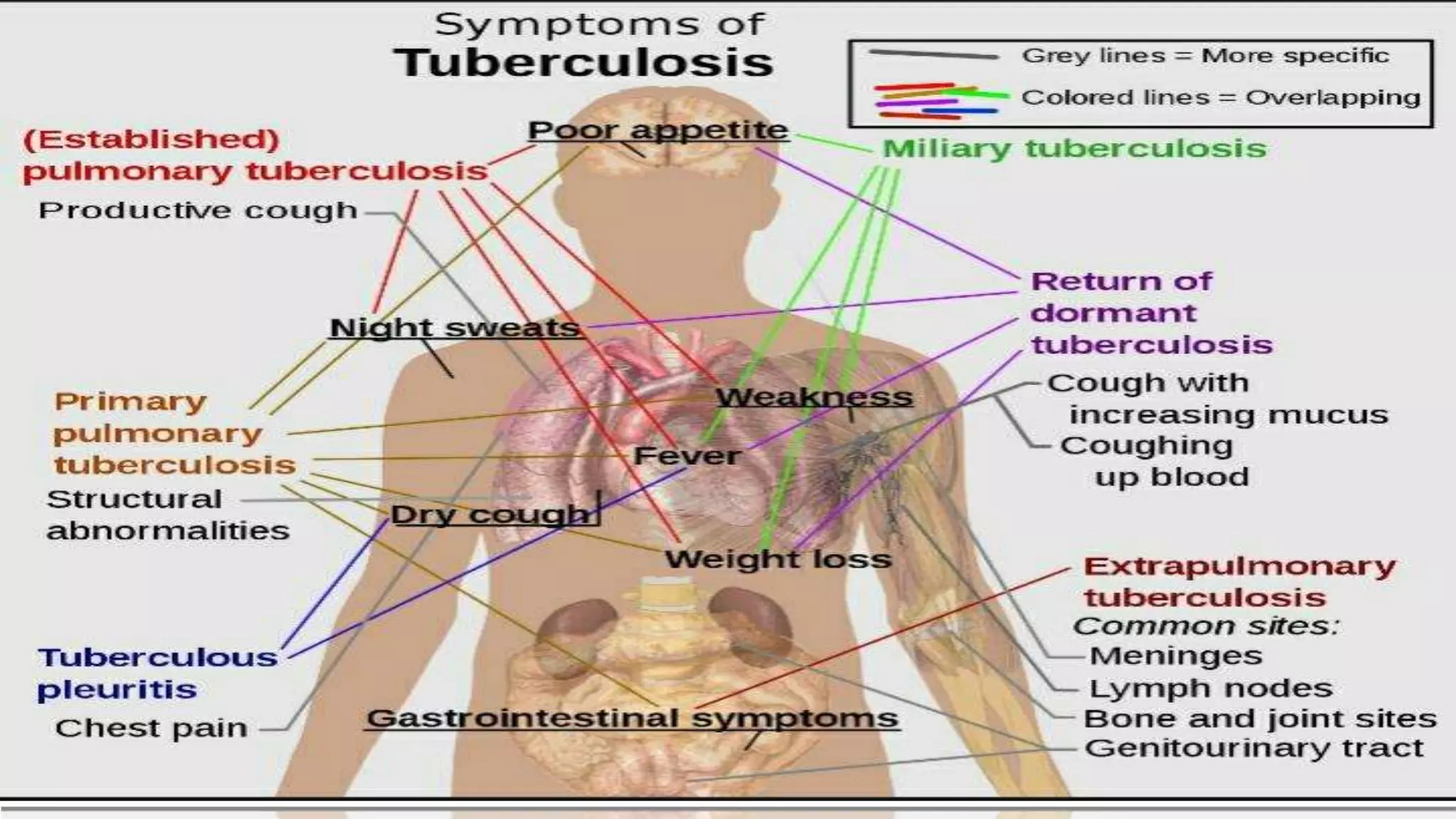 Mycobacterium tuberculosis-TB | PPTX