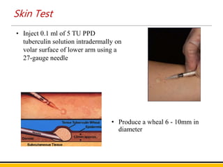 MYCOBACTERIUM TUBERCULOSIS | PPTX