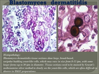 Blastomycosis Histology
