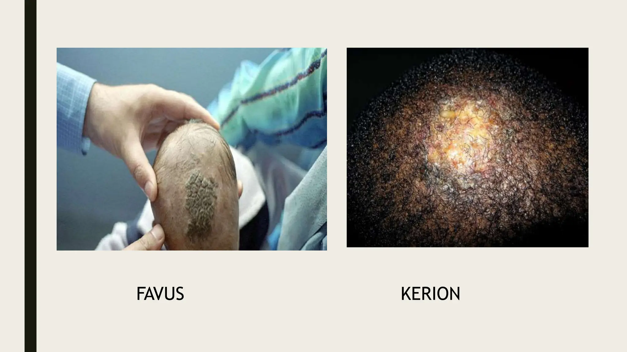 Mycosis-fungal diseases and basic information | PPTX