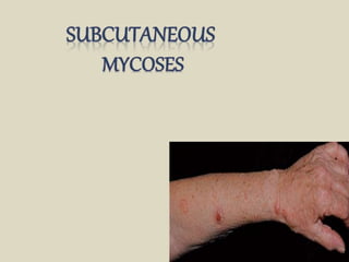 subcutaneous Mycosis & systemic mycosis | PPTX