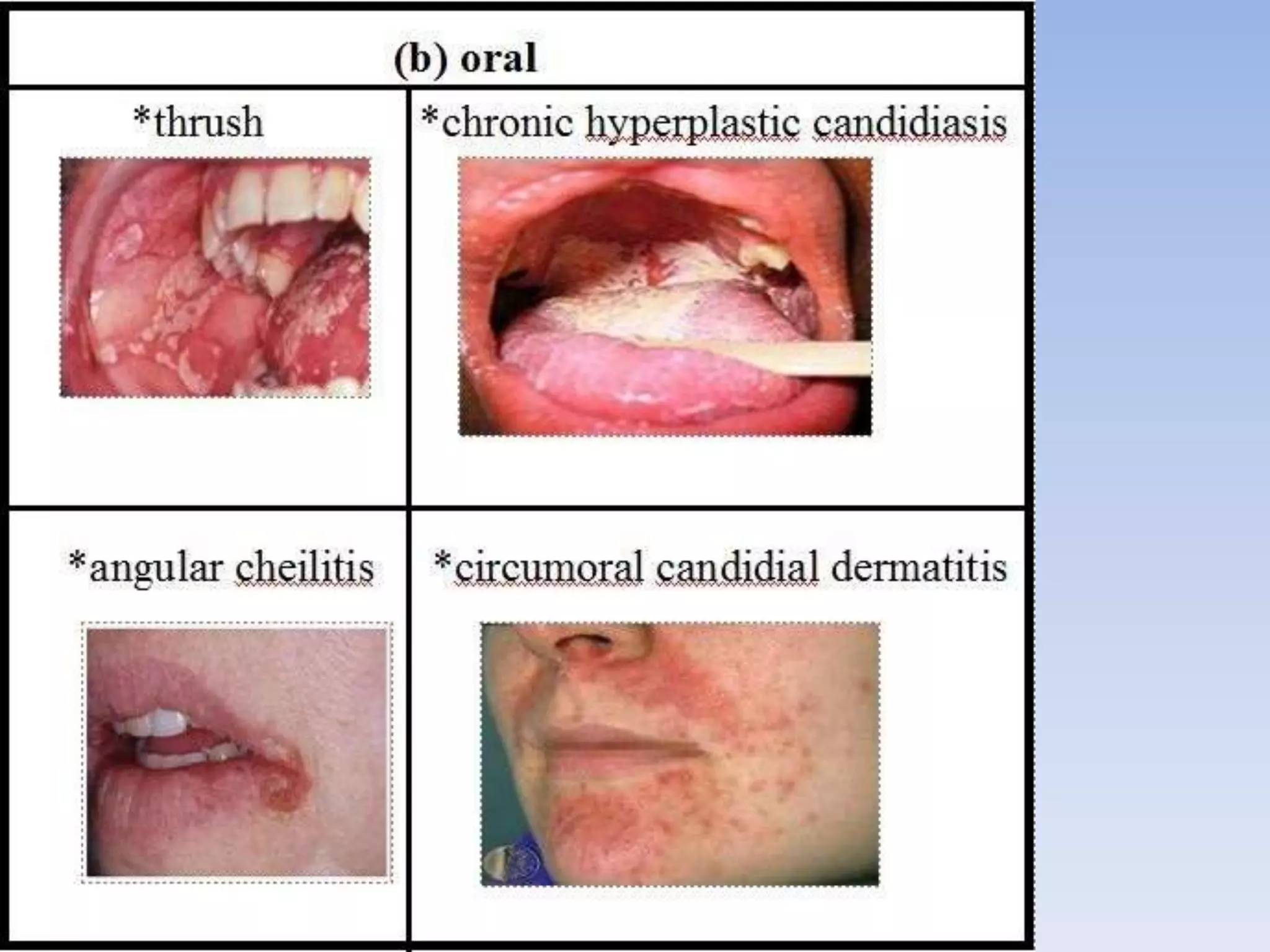 Mycotic(fungal) Infections | PPTX