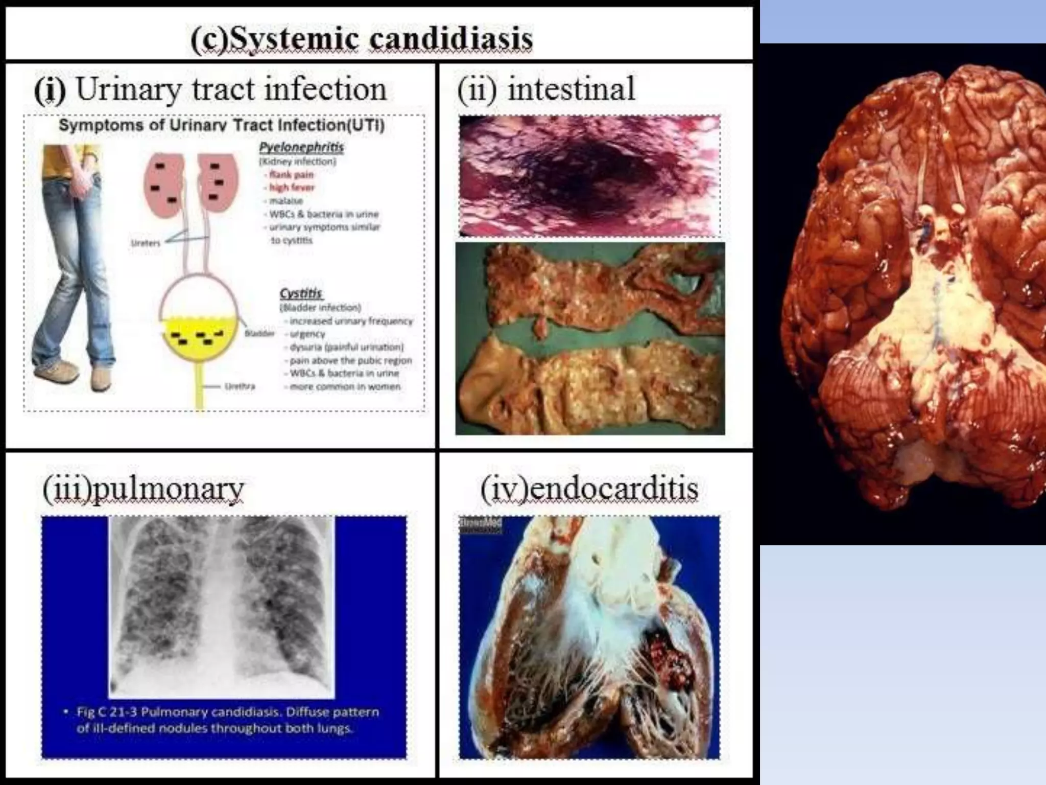 Mycotic(fungal) Infections | PPTX