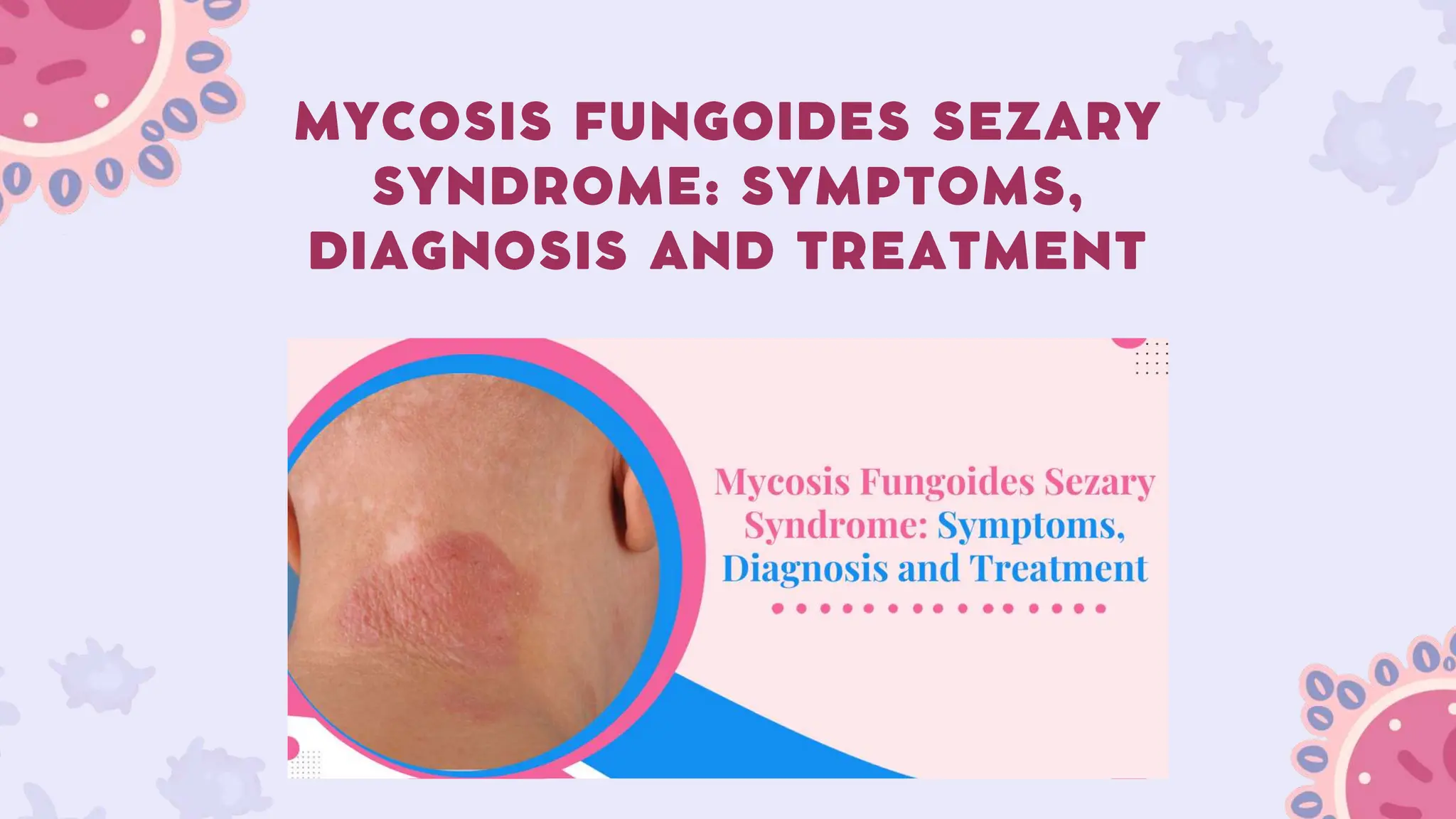 What Is Mycosis Fungoides Sezary Syndrome? | PPTX