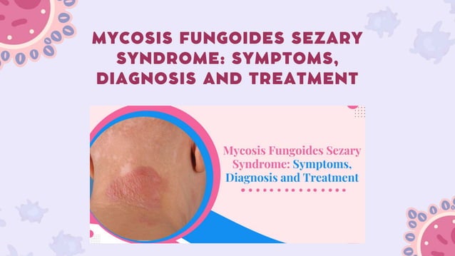 What Is Mycosis Fungoides Sezary Syndrome? | PPTX | Skin and Dermatology | Diseases and Conditions