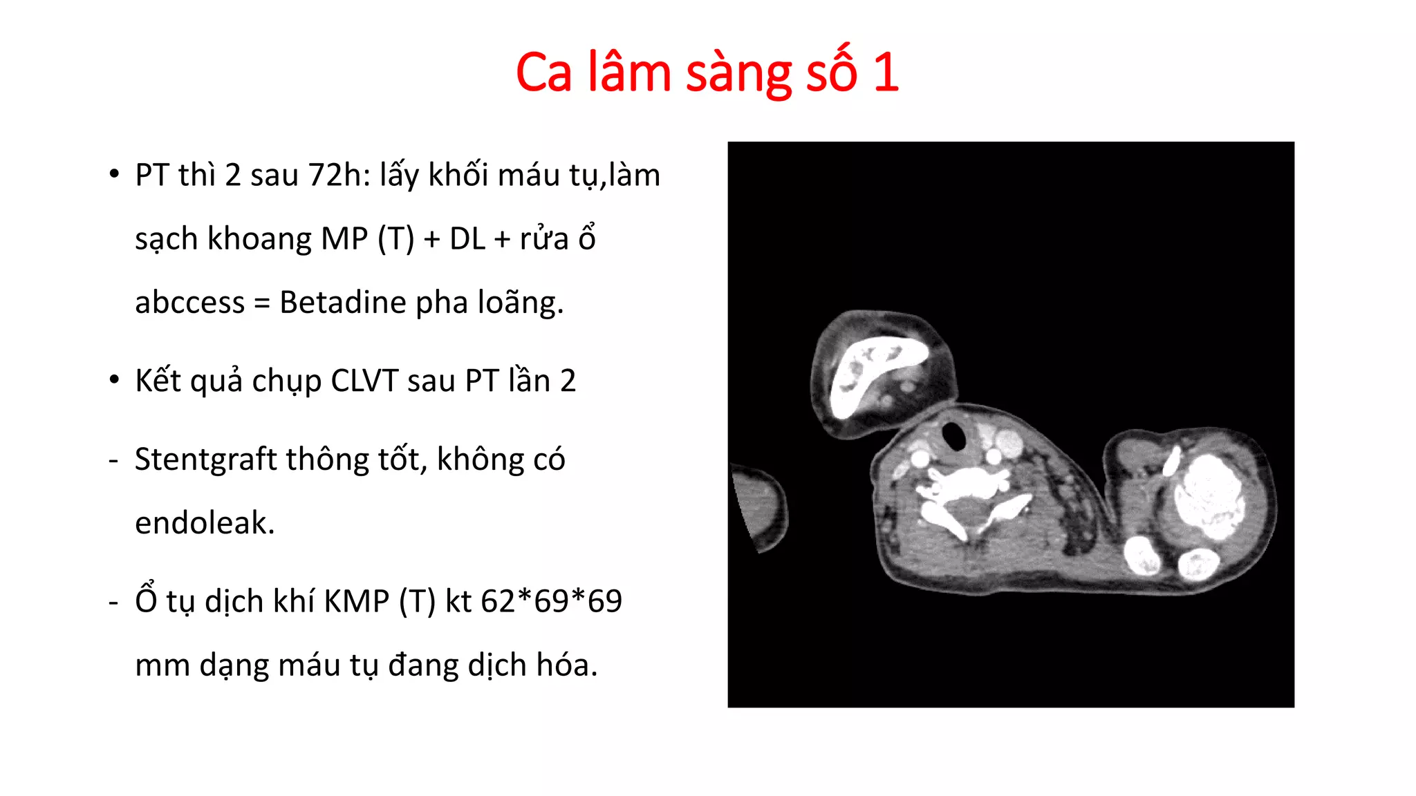 Mycotic Aortic Aneurysm Diseases - | PDF