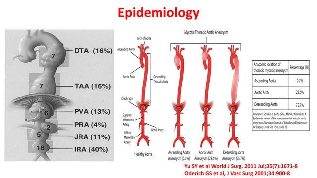 Mycotic Aortic Aneurysm Diseases - | PPT