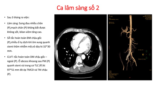 Mycotic Aortic Aneurysm Diseases - | PPT
