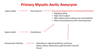 Mycotic Aortic Aneurysm Diseases - | PPT