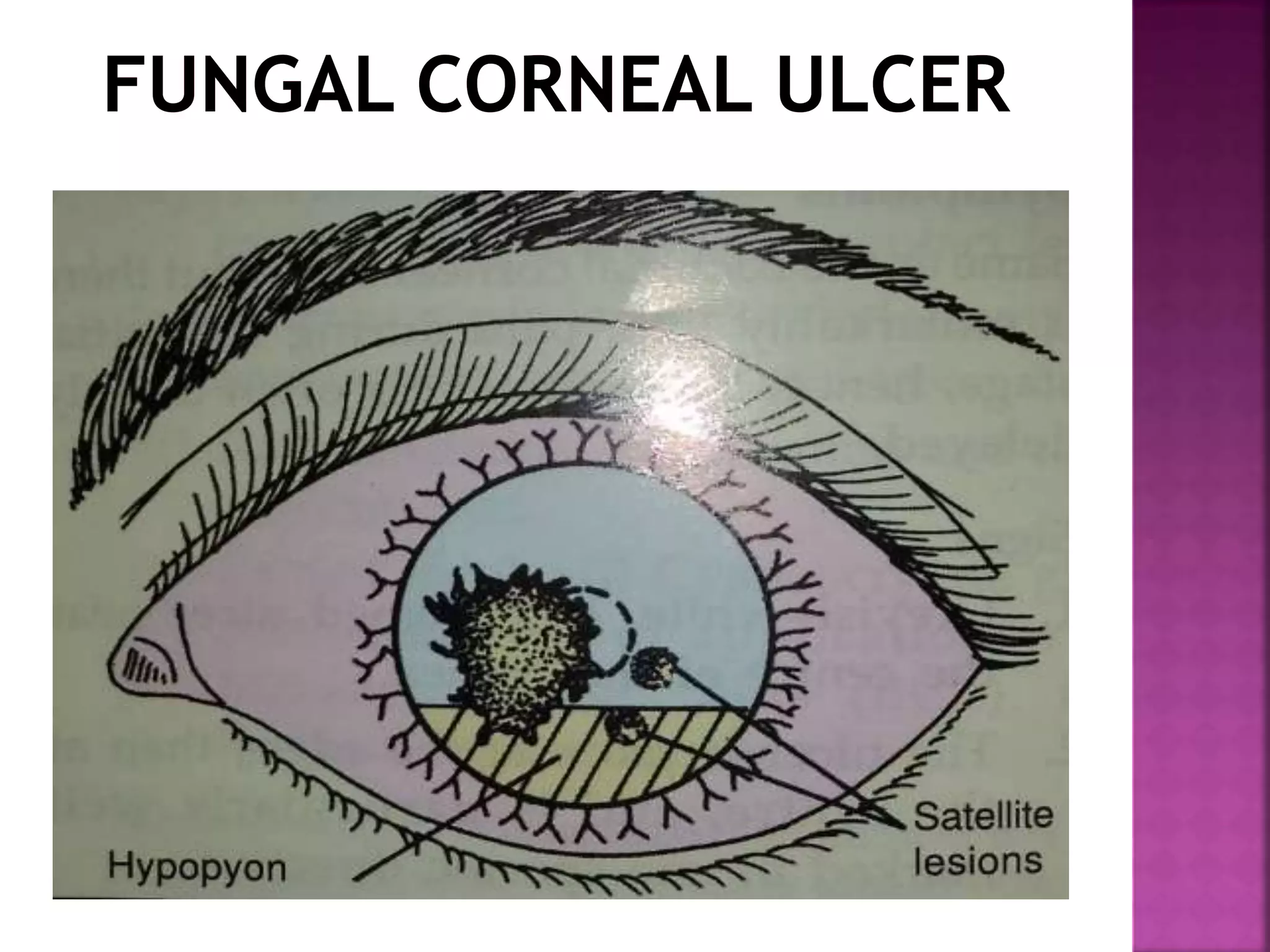 Mycotic keratitis | PPTX
