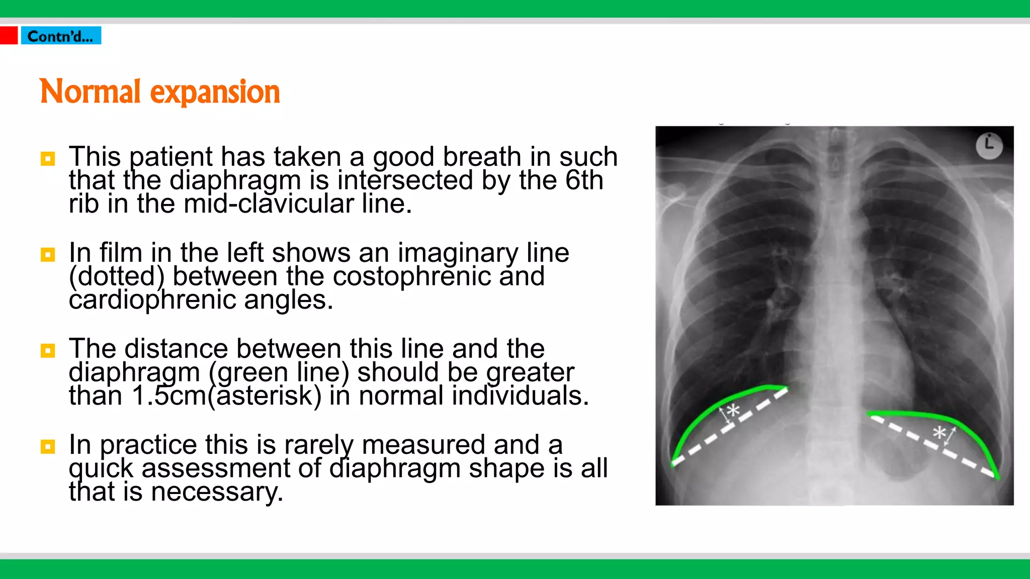 Chest X-ray: Basics | PPTX