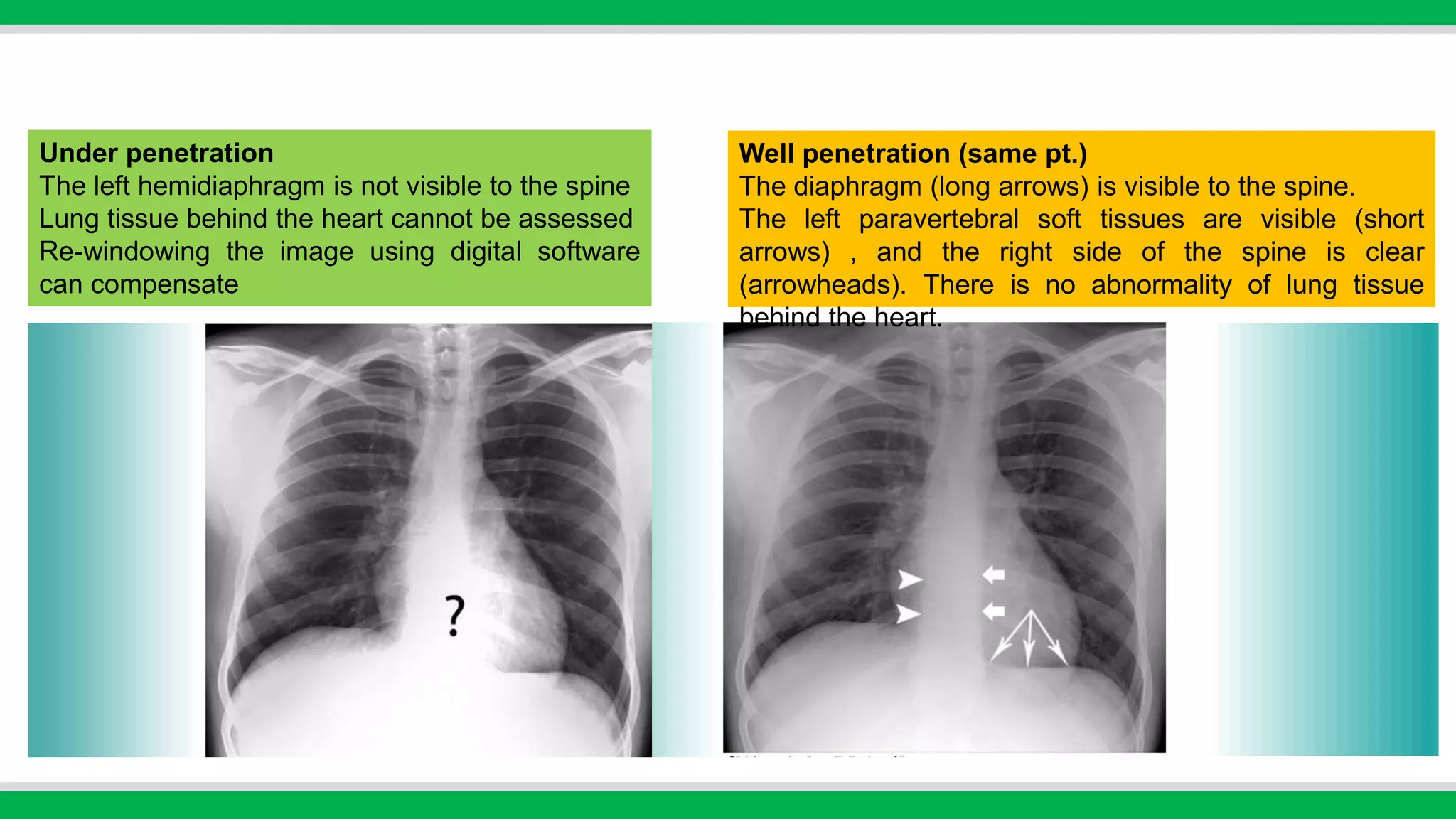 Chest X-ray: Basics | PPTX