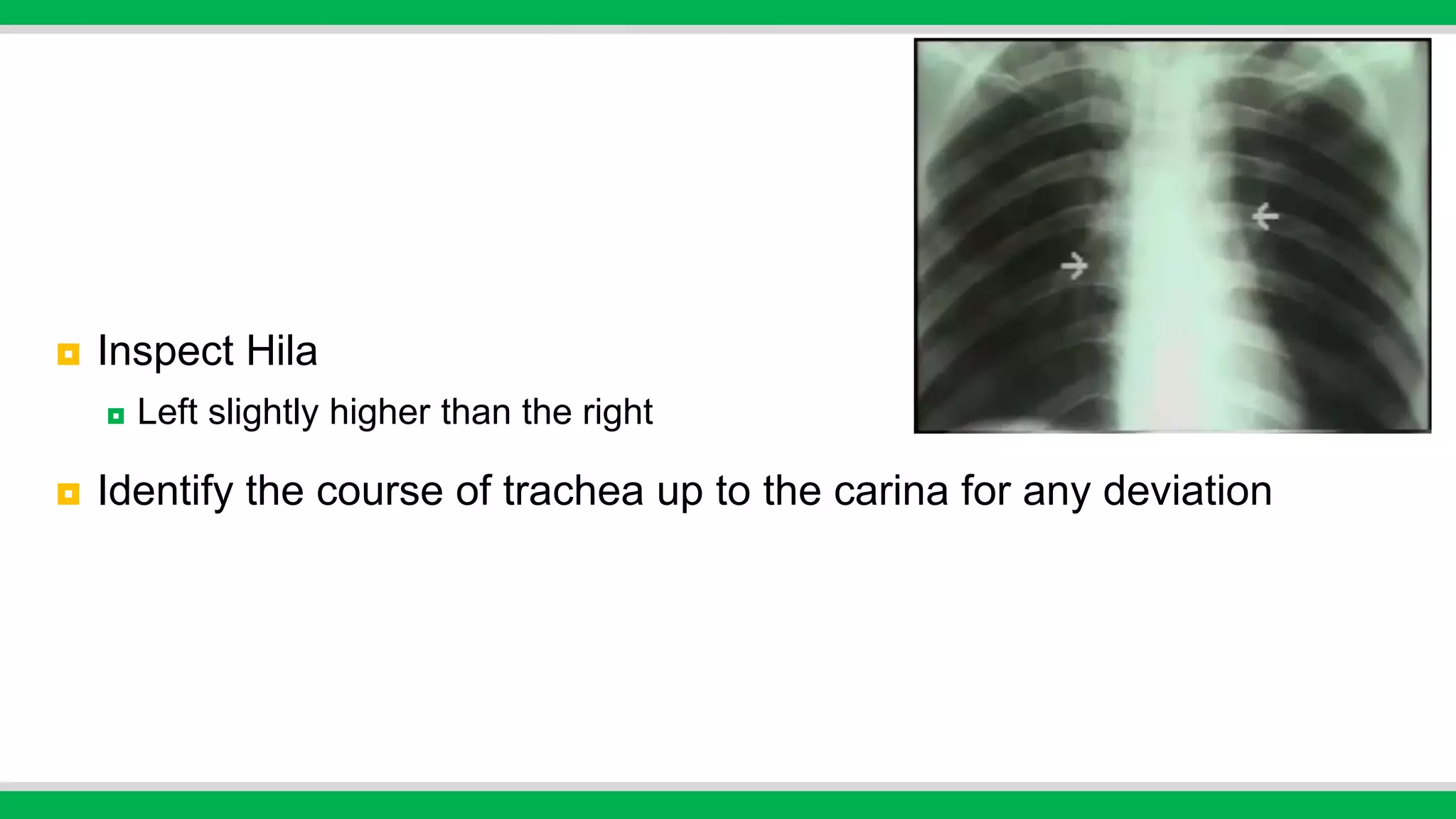 Chest X-ray: Basics | PPTX