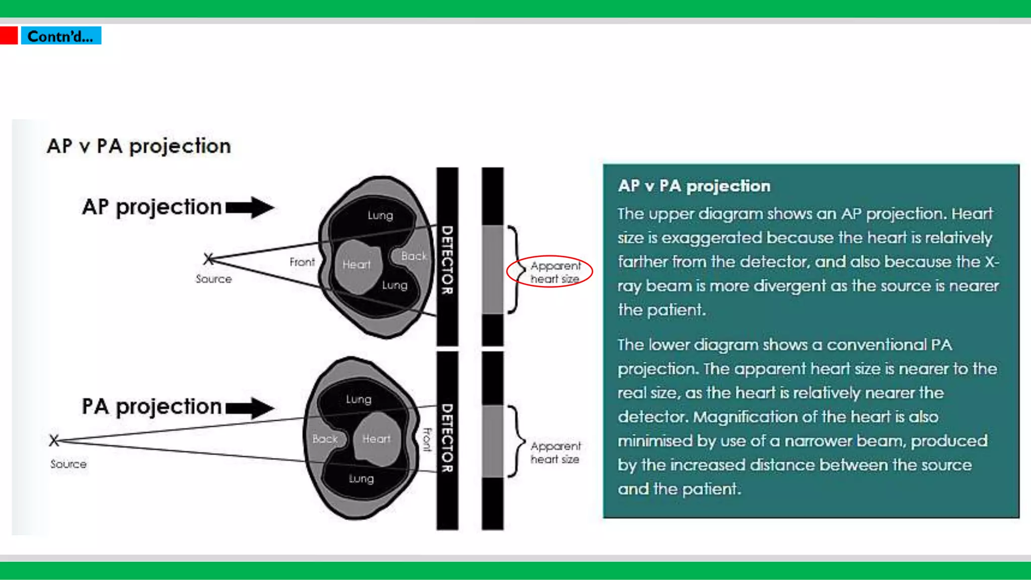 Chest X-ray: Basics | PPTX