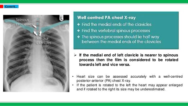 Chest X-ray: Basics