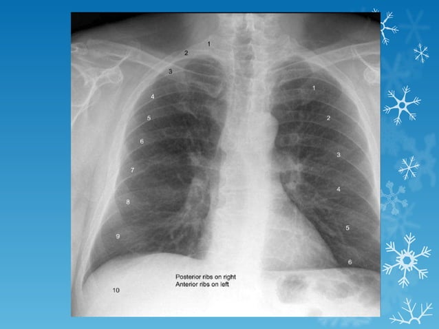 basics of chest X- ray interpretation | PPT | Lung and Respiratory Health | Diseases and Conditions