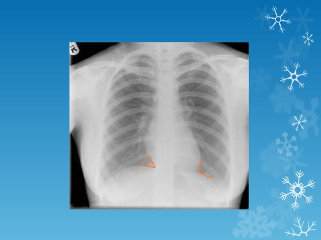 basics of chest X- ray interpretation | PPT | Lung and Respiratory ...