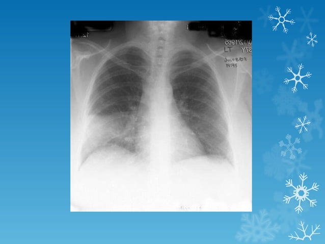 basics of chest X- ray interpretation | PPT | Lung and Respiratory ...