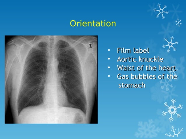 basics of chest X- ray interpretation | PPT | Lung and Respiratory Health | Diseases and Conditions