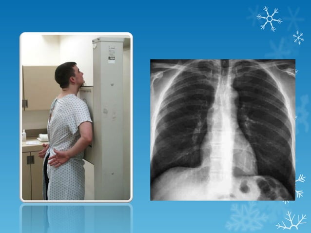 basics of chest X- ray interpretation | PPT | Lung and Respiratory ...