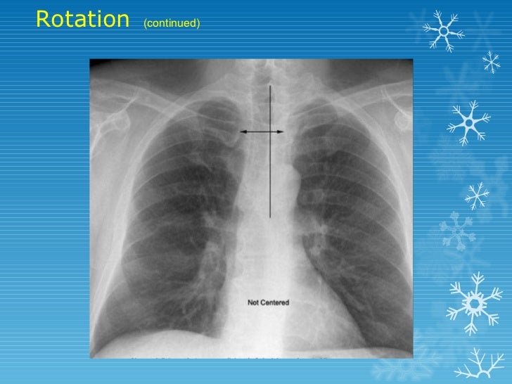 basics of chest X- ray interpretation