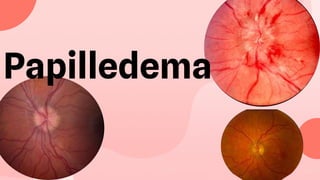 mydriasis, nystagmus, papilledema.pptx