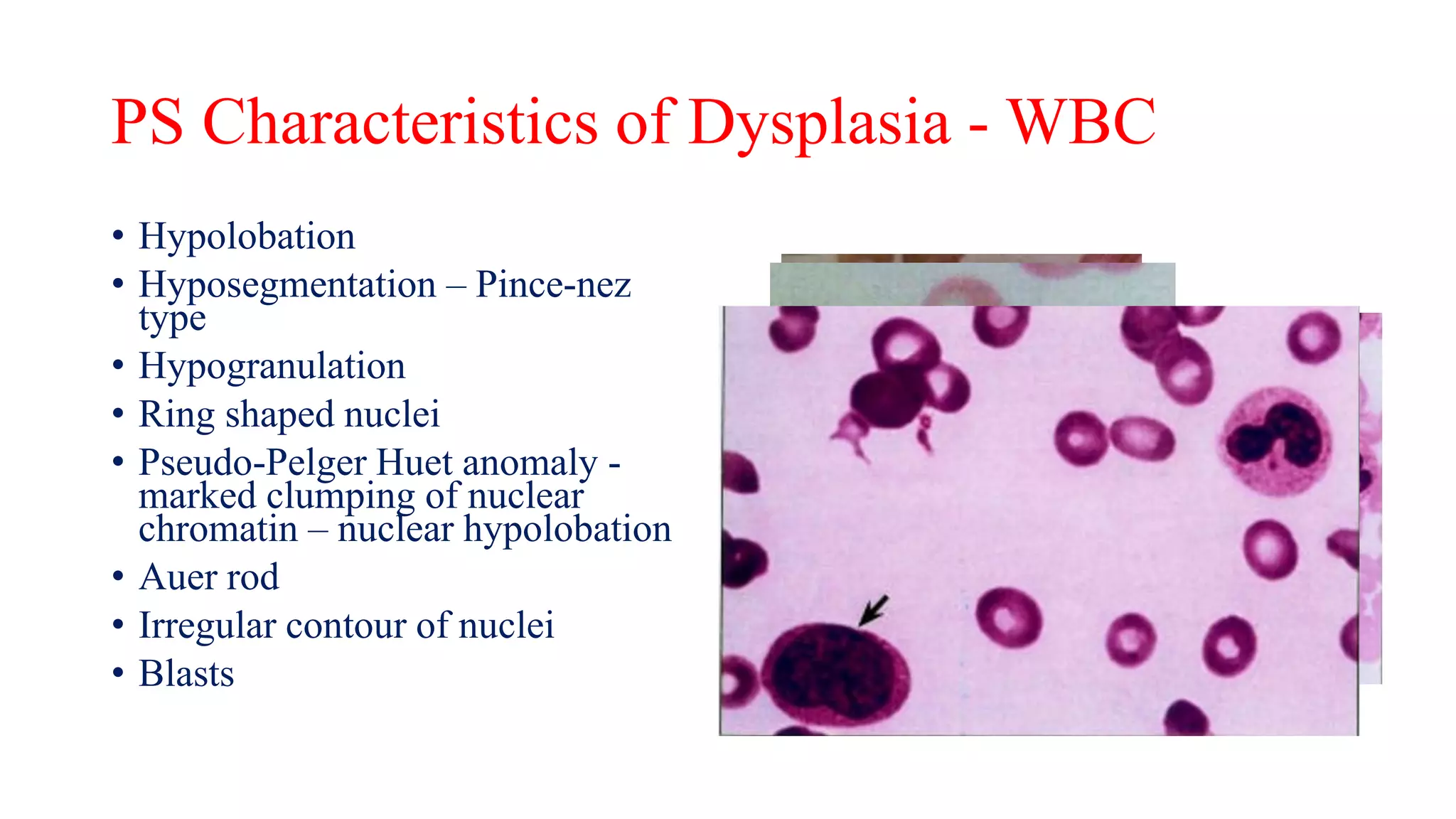 Myelodysplastic Syndrome.pptx