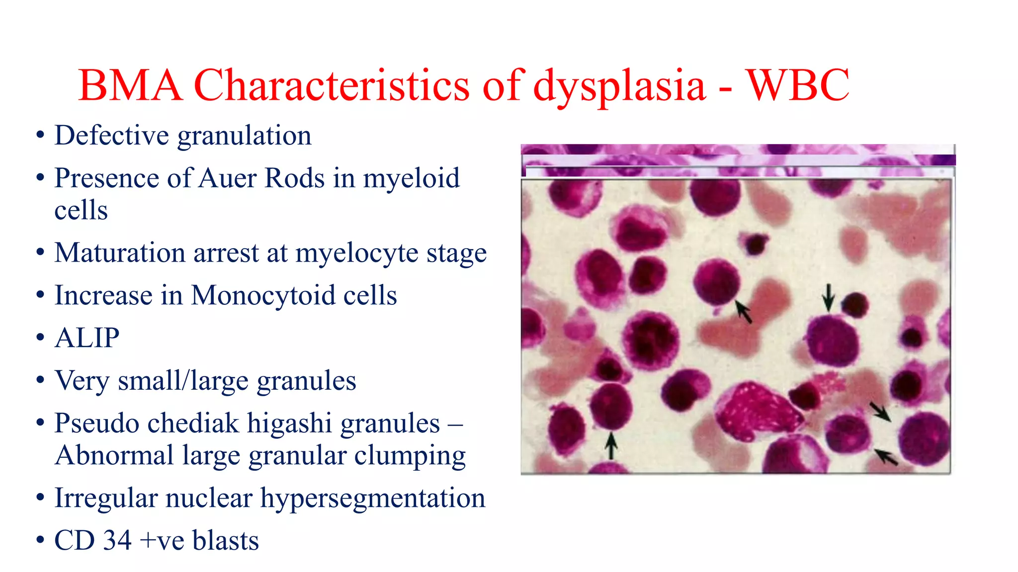 Myelodysplastic Syndrome.pptx