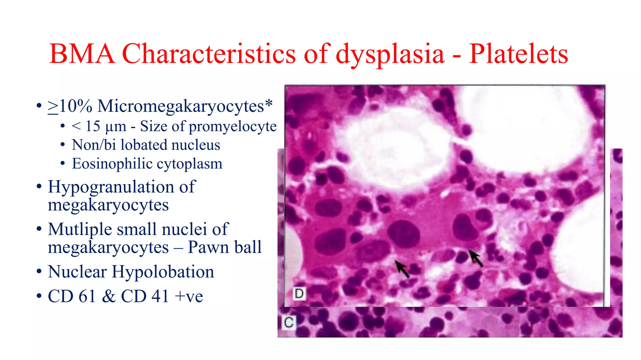 Myelodysplastic Syndrome.pptx