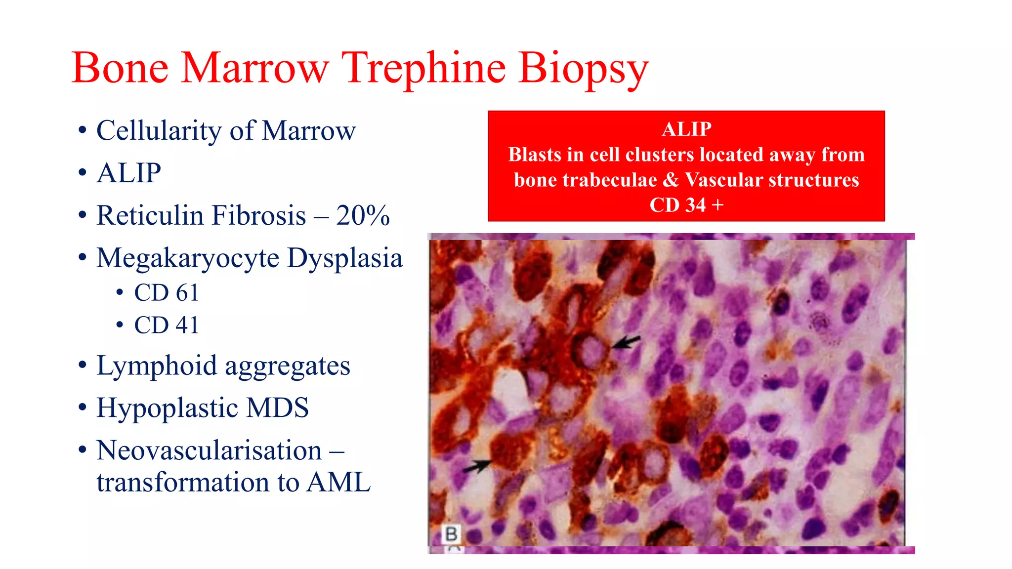 Myelodysplastic Syndrome.pptx